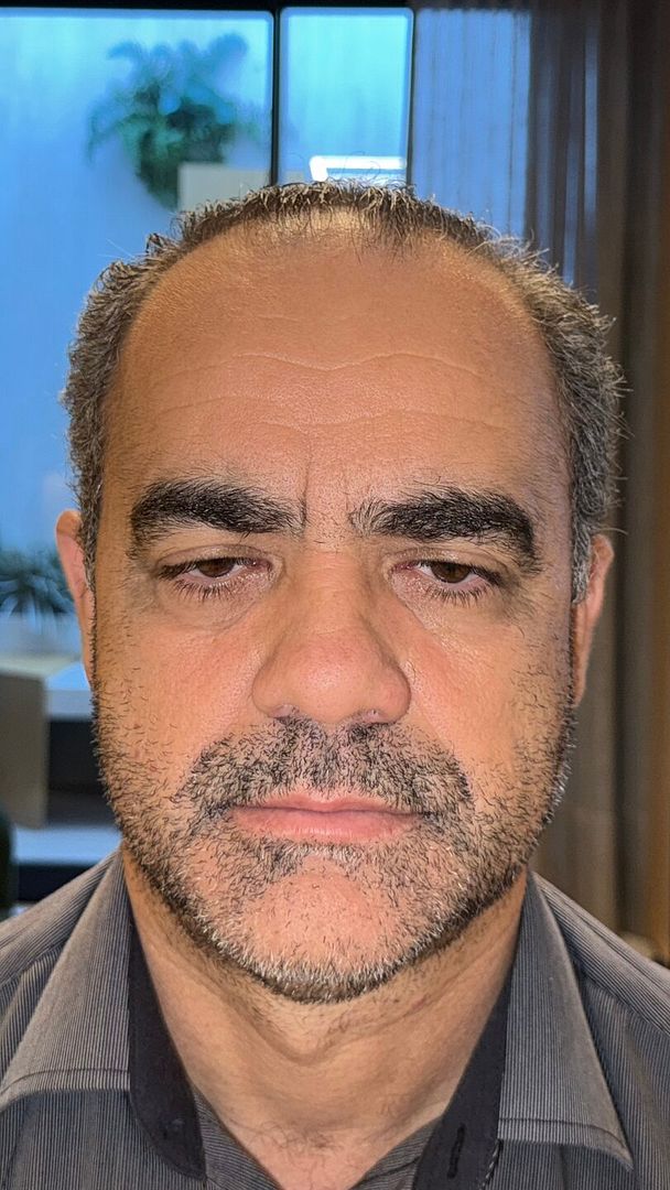 CASO DR.FELIPE PITTELLA - 13375 GRAFTS FUE+BHT