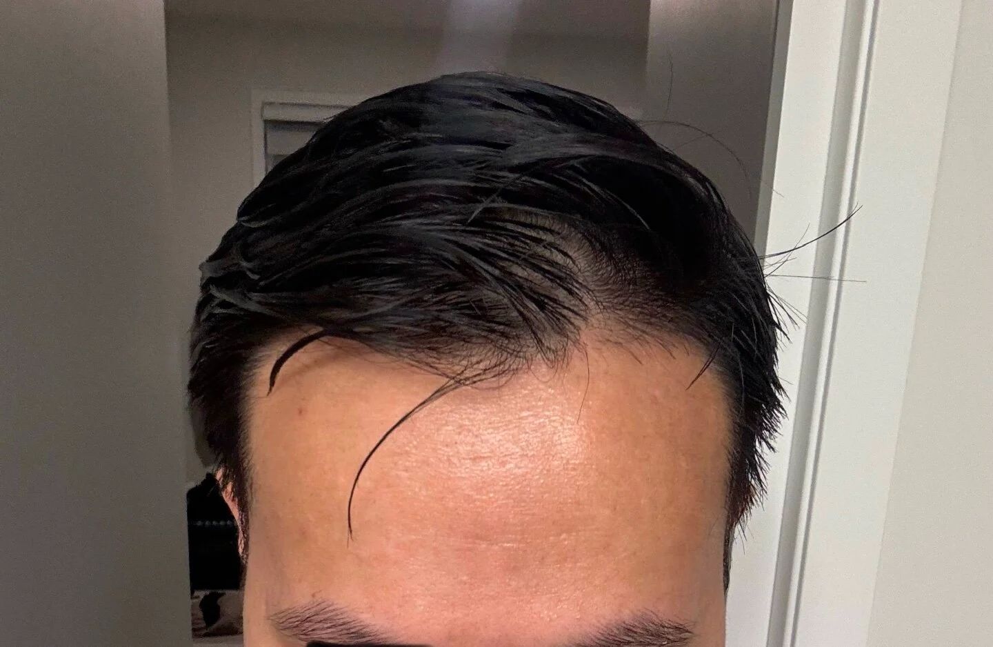 CASO DR.HASSON - 2100 GRAFTS FUE