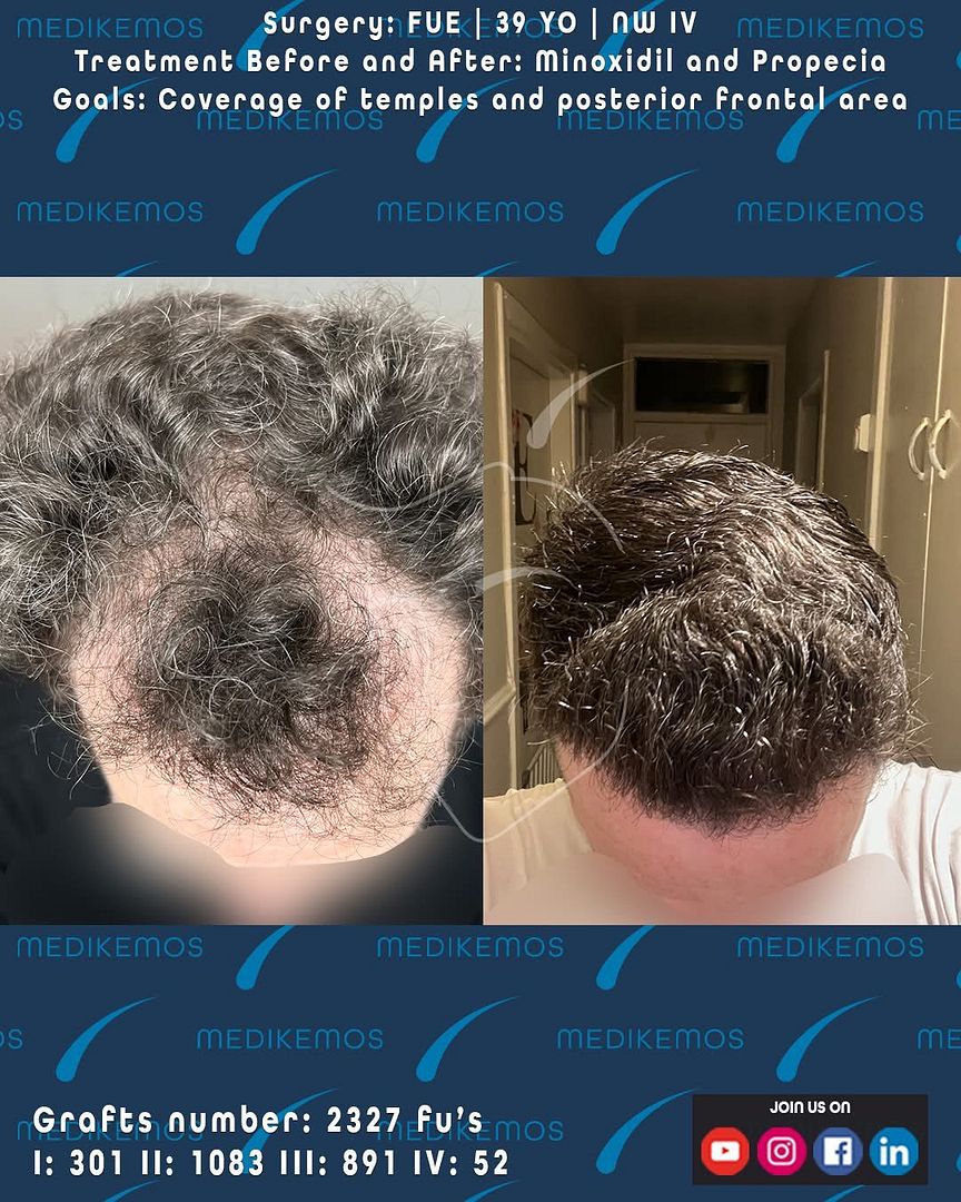 CASO DR.LUPANZULA | MEDIKEMOS - 2327 GRAFTS FUE Bellicapelli Forum
