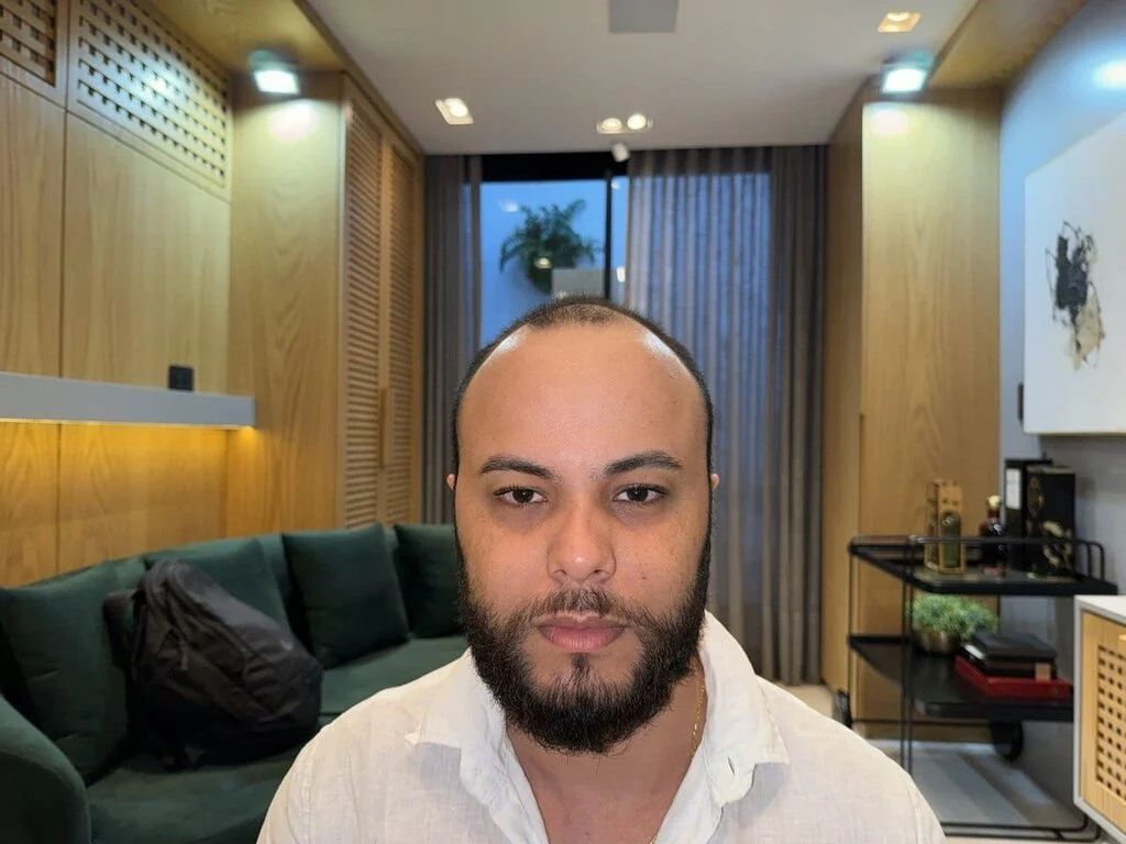 CASO DR.FELIPE PITTELLA - 7200 GRAFTS FUE