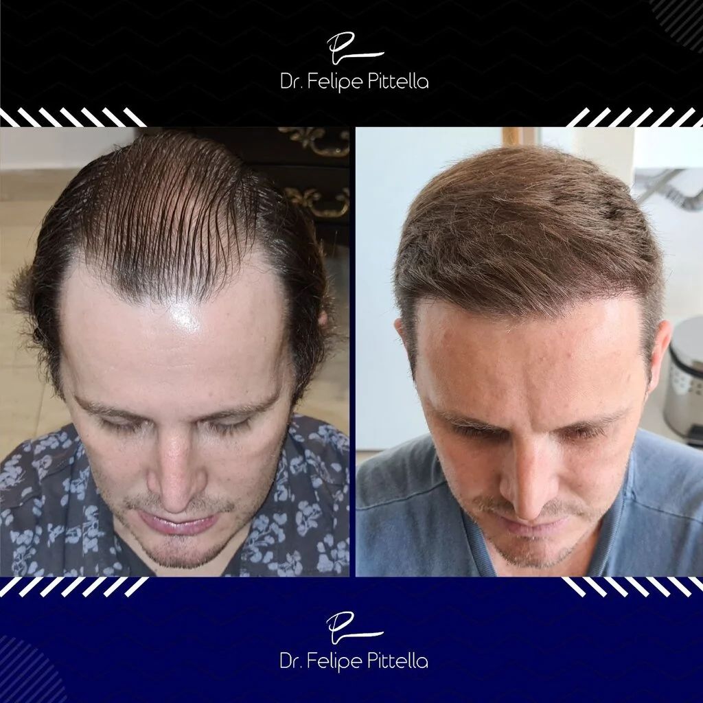 CASO DR.FELIPE PITTELLA - 5280 GRAFTS FUE