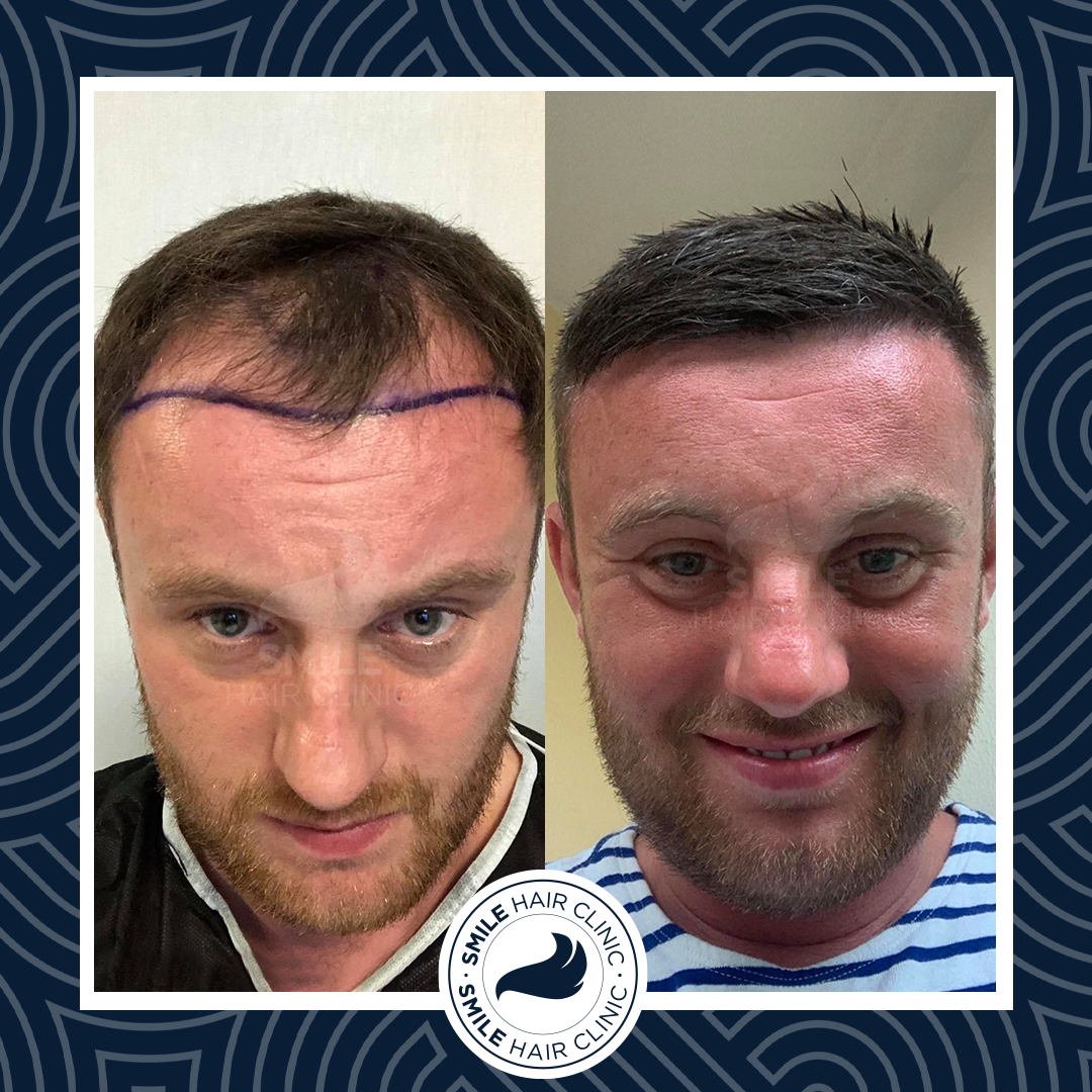 CASO SMILE HAIR CLINIC - 4200 GRAFTS FUE Bellicapelli Forum