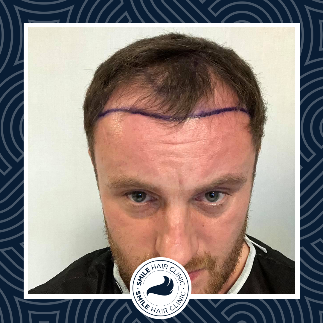 CASO SMILE HAIR CLINIC - 4200 GRAFTS FUE Bellicapelli Forum