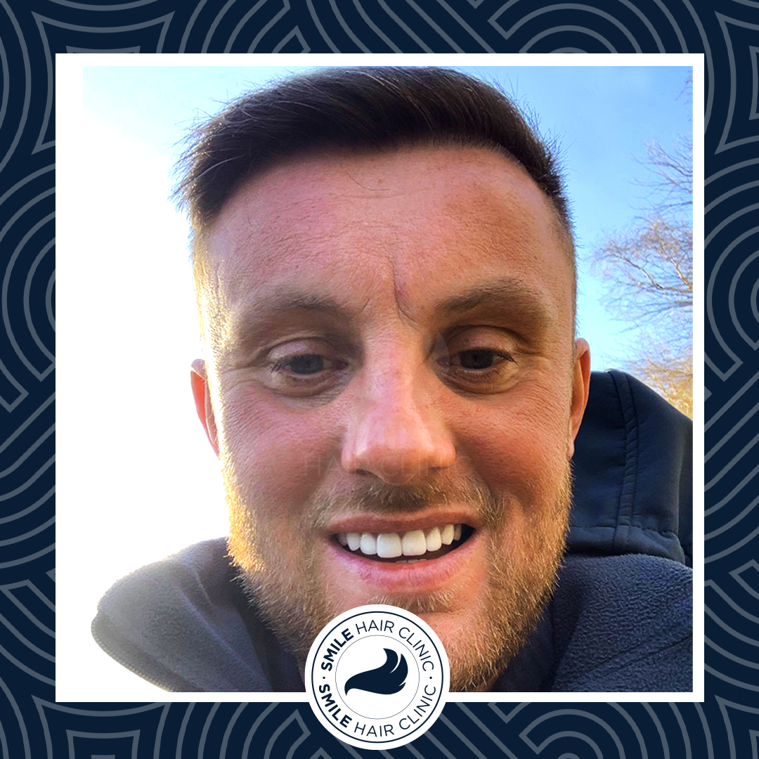 CASO SMILE HAIR CLINIC - 4200 GRAFTS FUE Bellicapelli Forum