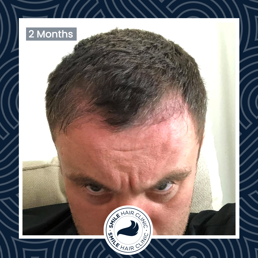 CASO SMILE HAIR CLINIC - 4200 GRAFTS FUE Bellicapelli Forum