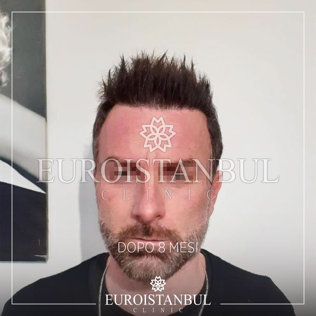 CASO CLINICA EUROISTANBUL - 3600 GRAFTS FUE Bellicapelli Forum