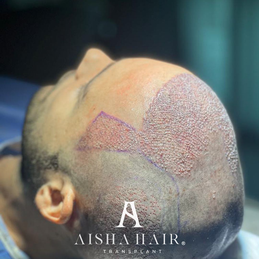CASO AISHA HAIR TRANSPLANT - 3500 GRAFTS FUE Bellicapelli Forum