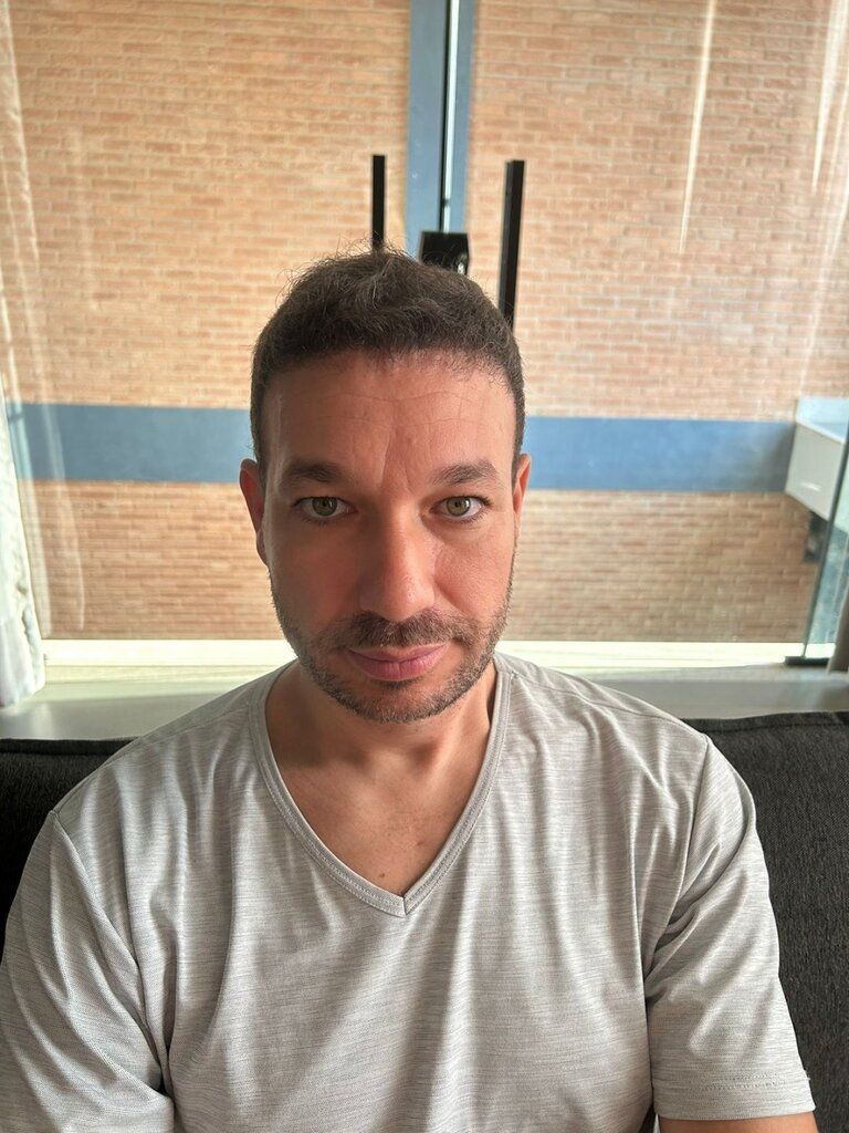 DR.FELIPE PITTELLA 11.026 GRAFTS FUE+BHT (REPAIR) - Dr. Felipe Pittella