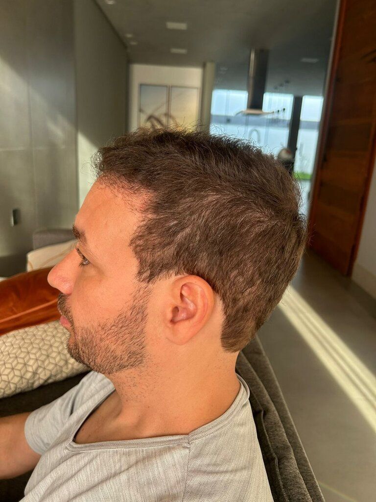 DR.FELIPE PITTELLA 11.026 GRAFTS FUE+BHT (REPAIR) - Dr. Felipe Pittella