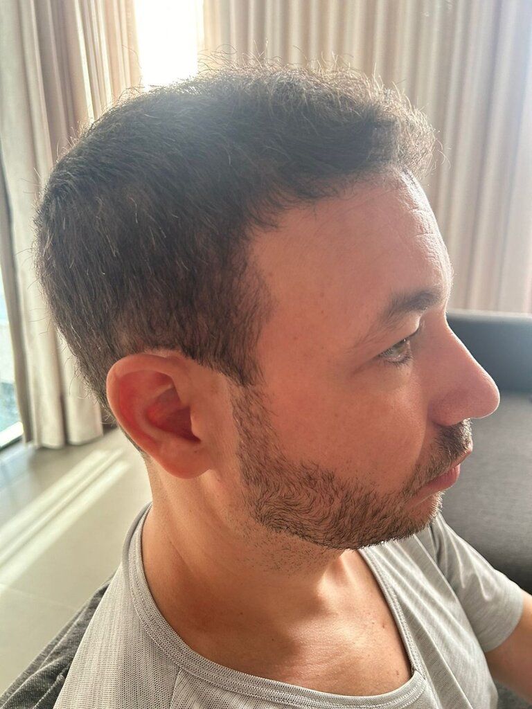 DR.FELIPE PITTELLA 11.026 GRAFTS FUE+BHT (REPAIR) - Dr. Felipe Pittella
