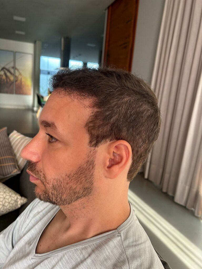DR.FELIPE PITTELLA 11.026 GRAFTS FUE+BHT (REPAIR) - Dr. Felipe Pittella