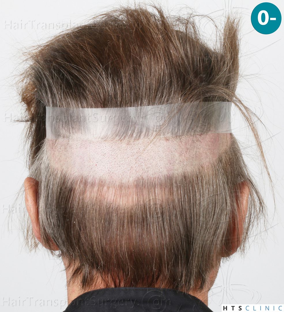 DR. DEVROYE + DR. MONTESANTI + DR. JENARD / 1810 FUE PARTIAL SHAVE ...