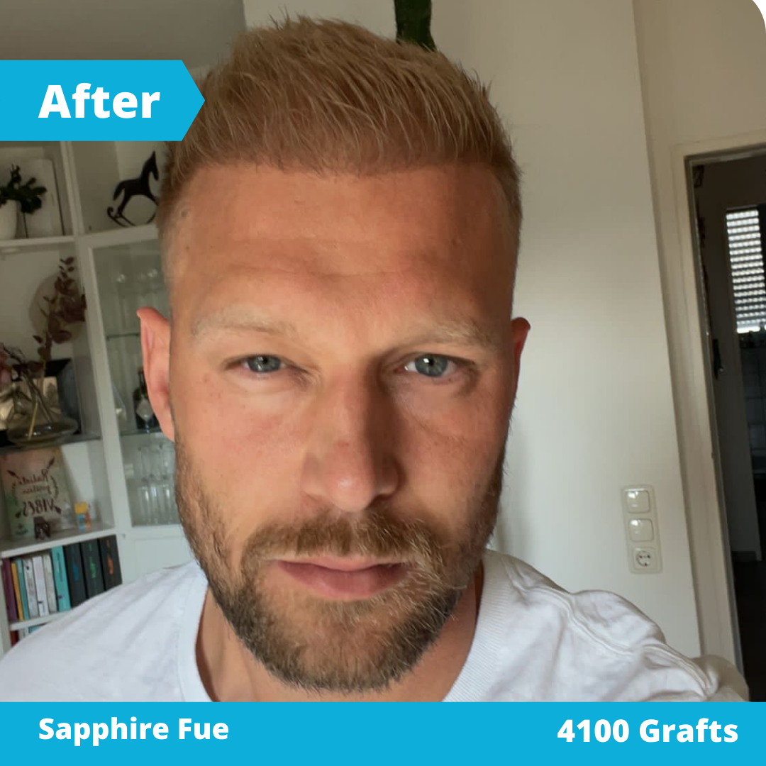 CASO VERACLINIC - 4100 GRAFTS Bellicapelli Forum