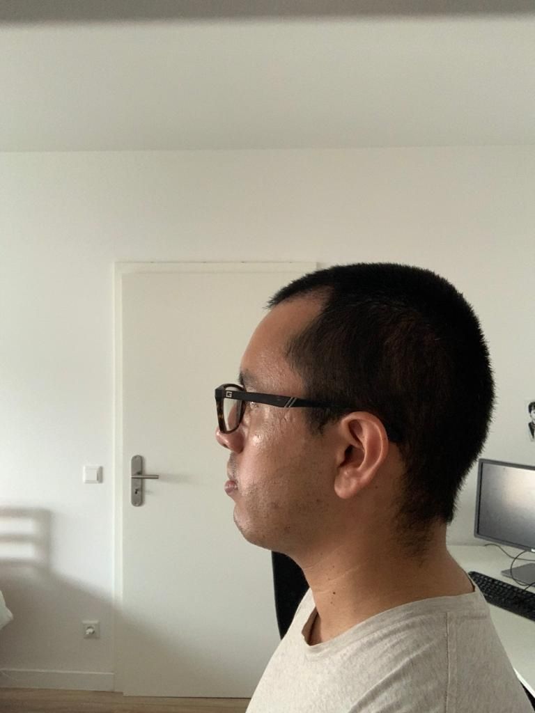 DR. ÖZLEM BIÇER - 3870 GRAFTS FUE - BEARD RECONSTRUCTION Bellicapelli Forum